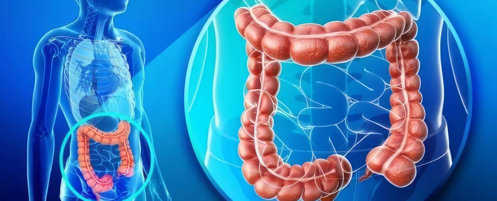 Cancerul Colorectal: Factori de Risc și Metode de Prevenire Eficiente ...