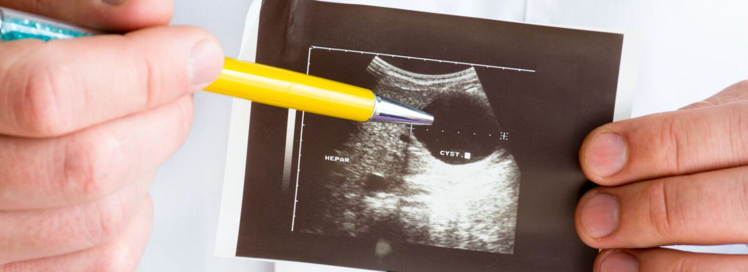 Ghid de diagnostic si tratament al chistului hidatic hepatic – Dr ...